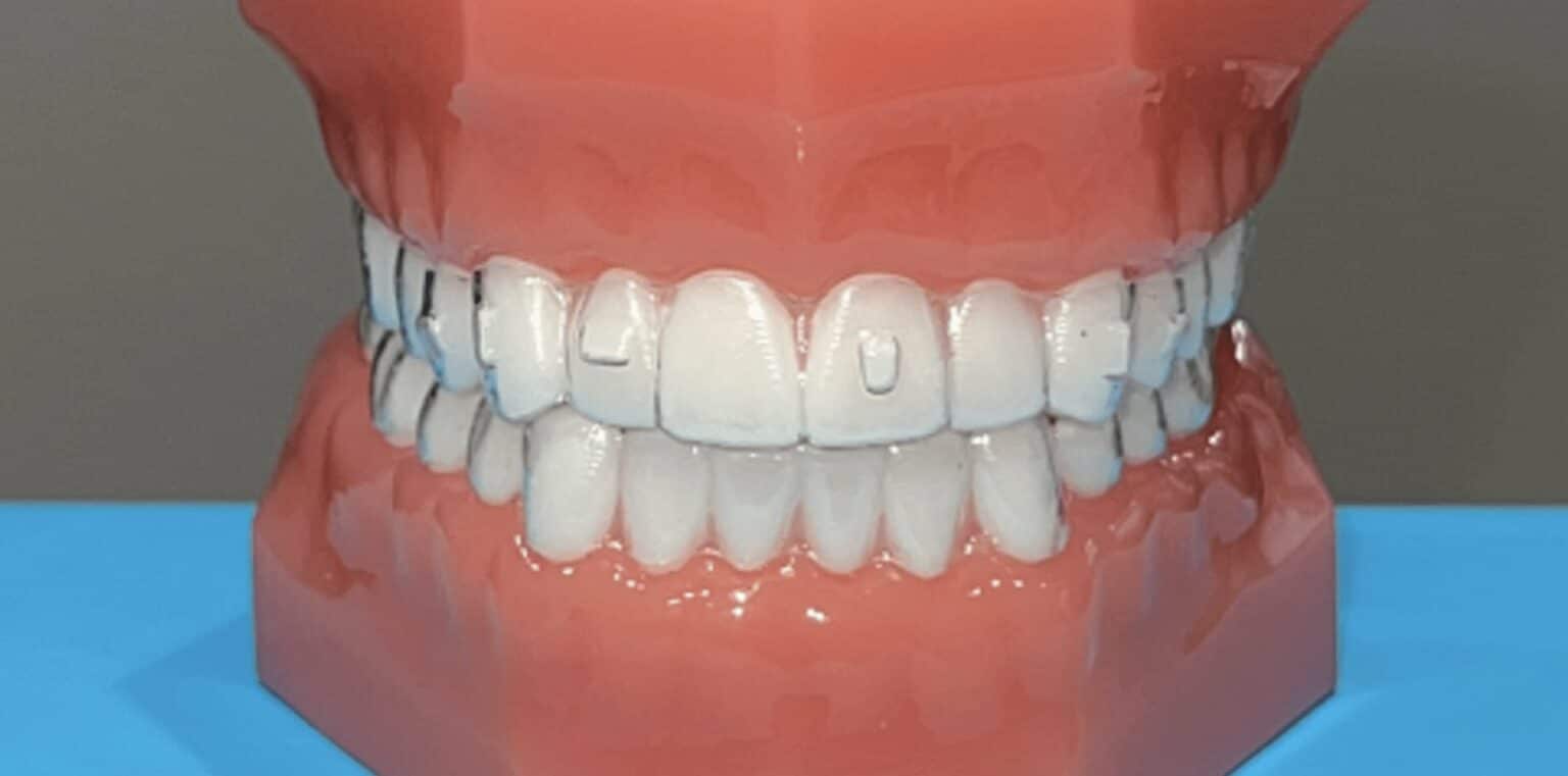 Are "Do It Yourself" (DIY) Aligners Safe? Escondido CA | Happier Smiles ...