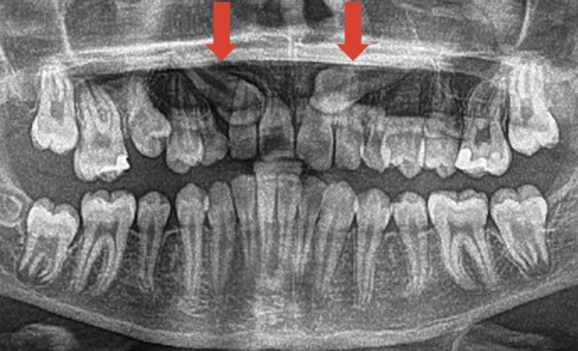 Are "Do It Yourself" (DIY) Aligners Safe? Escondido CA | Happier Smiles ...