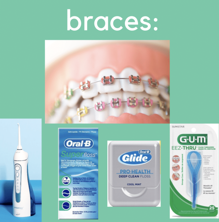 How to Keep My Teeth Clean with Braces and Clear Aligners | Happier ...