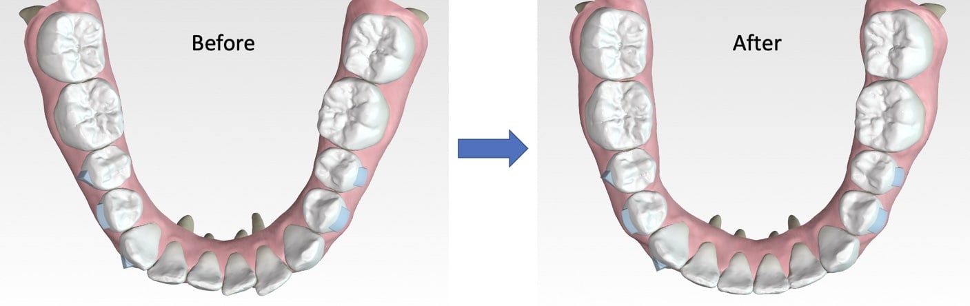 How Do Clear Aligners Work? - Orthodontist Escondido CA Invisalign ...